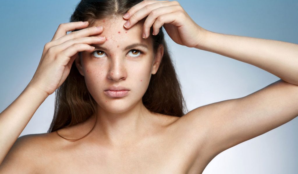 Acne Between Eyebrows: Causes, Symptoms, Treatment, Prevention, & More ...