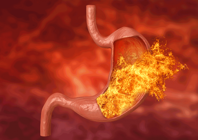 Gastropathy: Causes, Symptoms, Diagnosis, Treatment, Prevention ...