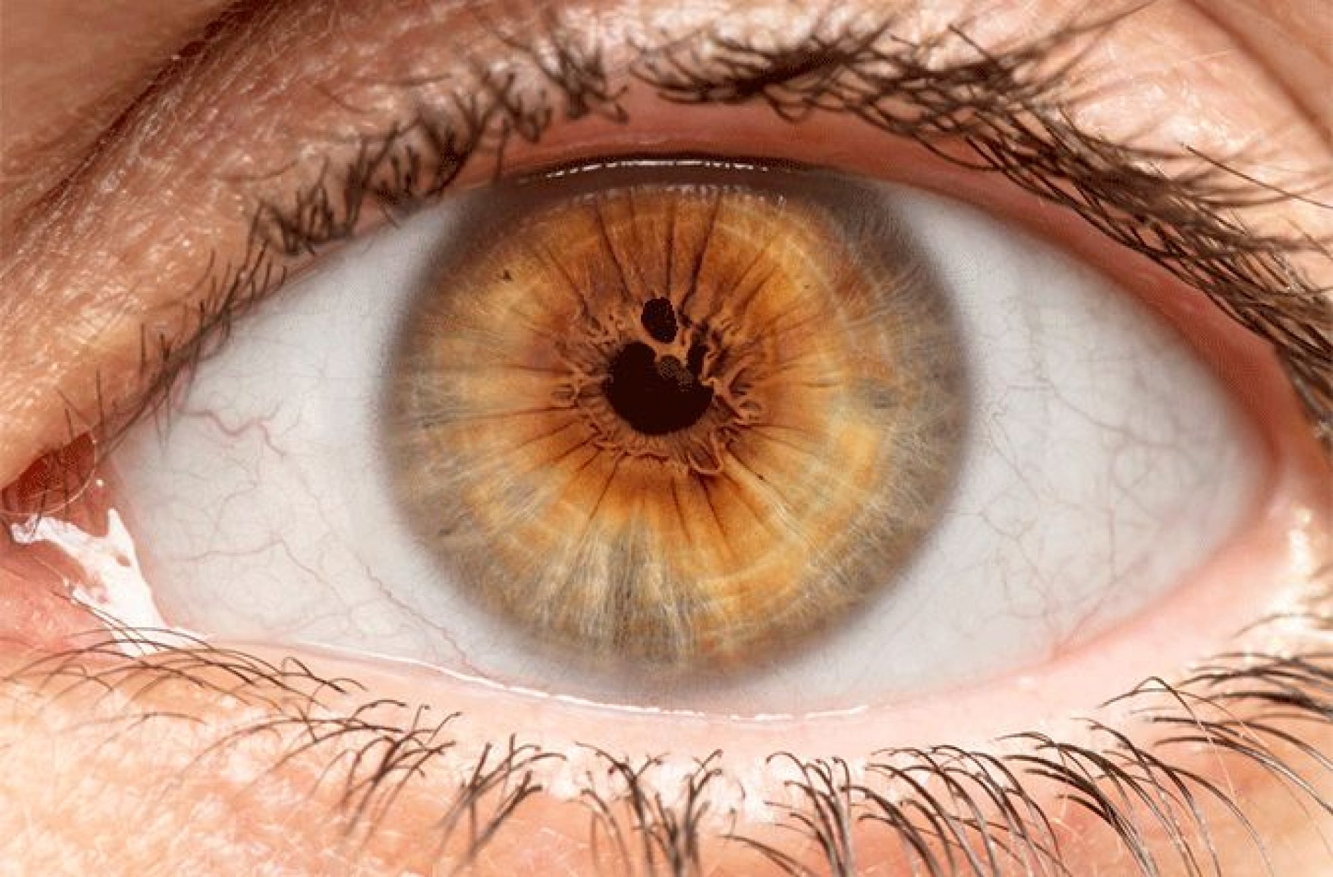 Polycoria: Causes, Symptoms, Diagnosis, Treatment, Prevention, & More ...